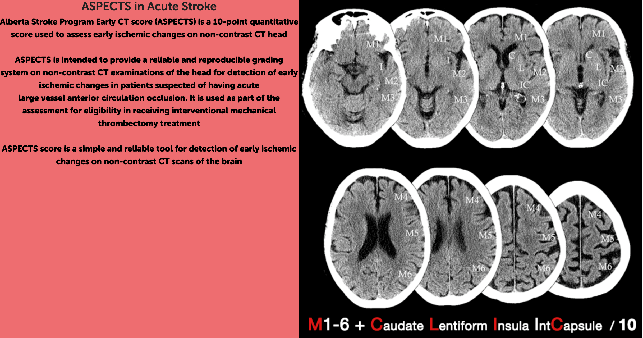 Six Pivotal Developments in Stroke Treatment and Care | arch magazine